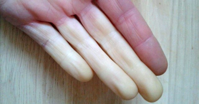16 choses que seules les personnes atteintes de la maladie de Raynaud ...
