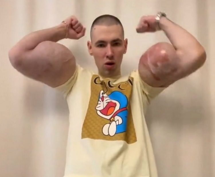 Le « Popeye russe » inquiète ses fans avec des images de ses bras ...